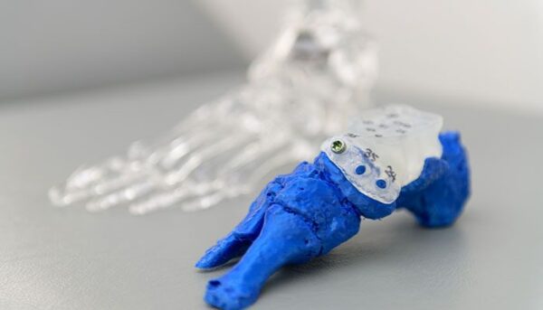 3D Printed Implants: The Top Applications - 3Dnatives