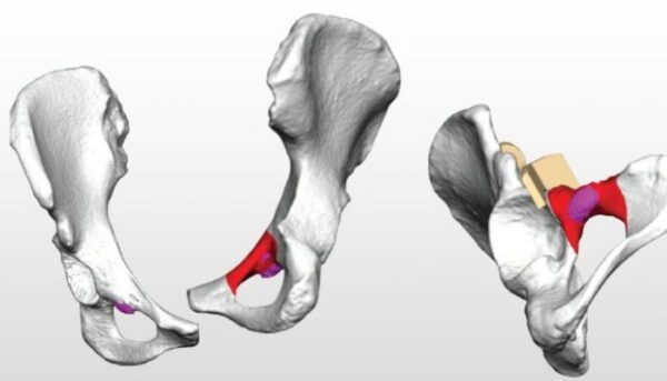 Onkos Surgical’s Pelvic Reconstruction System Receives FDA Clearance ...