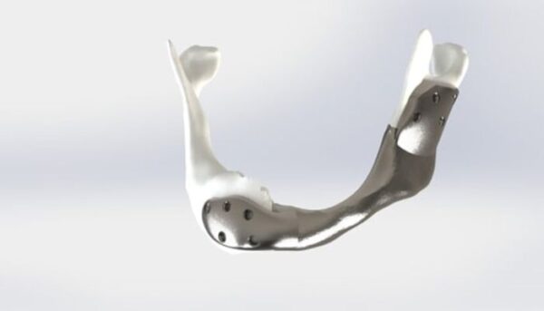 First 3D-Printed Titanium Jaw Successfully Transplanted on Cancer ...