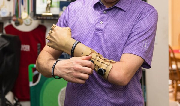 #3DStartup: Unlimited Tomorrow and its 3D Printed Bionic Prosthetic Arm ...