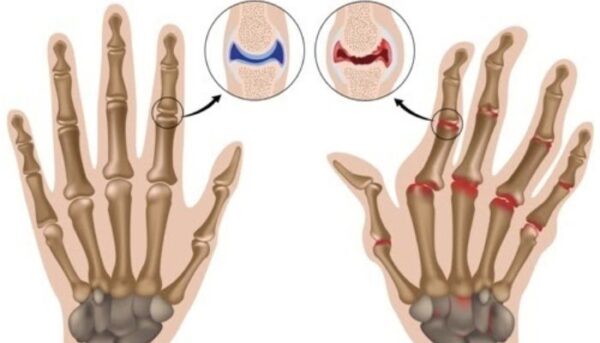 3D Printed Finger Implants Could Revolutionize Rheumatic Disorder ...