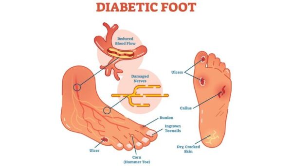 Breakthrough In Diabetic Foot Ulcer Treatment With 3D Printed Wound ...