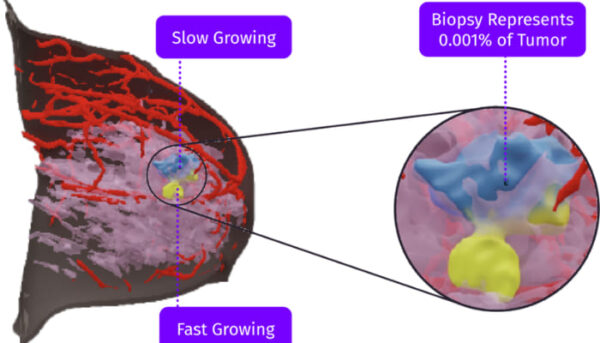 3D Printing Applications in the Fight Against Breast Cancer - 3Dnatives