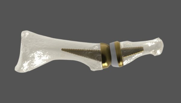 Anatomic Implants Seeks FDA Clearance for World's First 3D Printed Toe ...