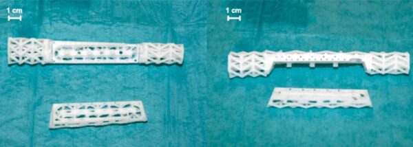 3D-Printed Scaffold Used in Treatment for Patient With Gunshot Wound ...