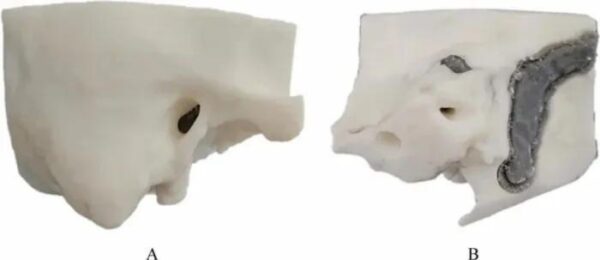 3D Printed Mastoidectomy Simulator Improves Surgeon Training and ...
