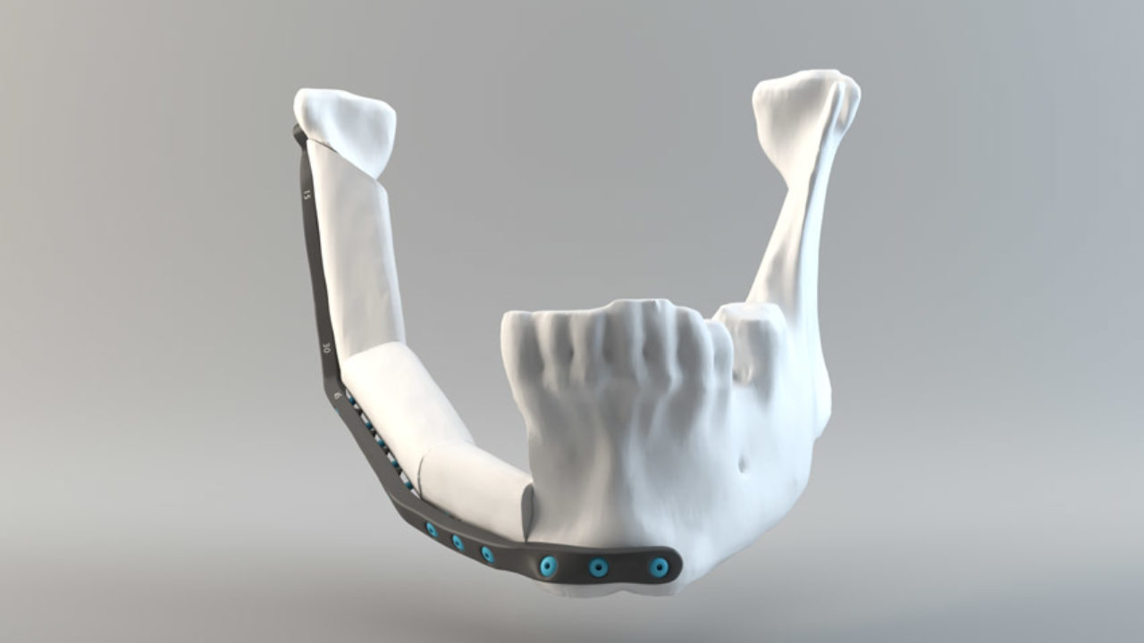 3d Printed Jaw Prosthetic