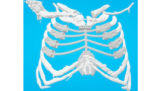 Patient receives a 3D printed rib cage implant - 3Dnatives