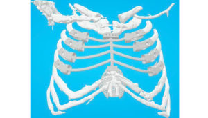 Patient receives a 3D printed rib cage implant - 3Dnatives