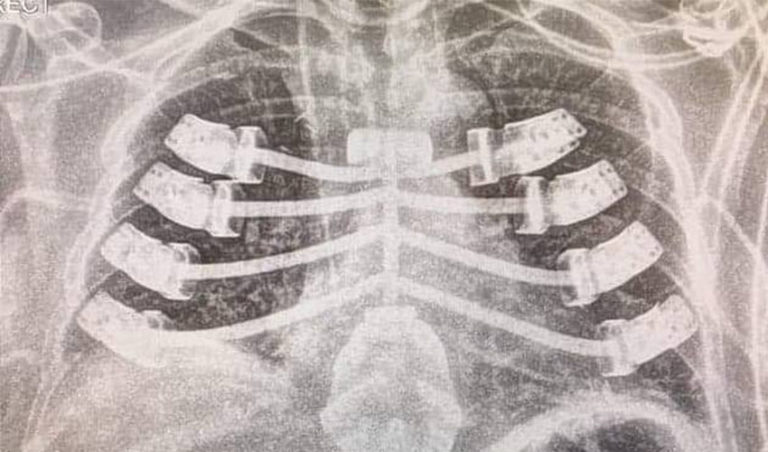 Patient receives a 3D printed rib cage implant - 3Dnatives