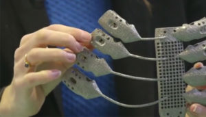 Patient receives a 3D printed rib cage implant - 3Dnatives