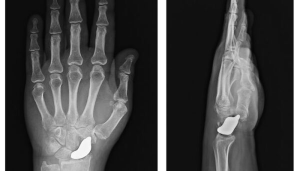 La prima protesi per polso stampata in 3D in Italia – 3Dnatives