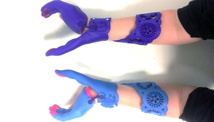 Orthèses imprimées en 3D : notre sélection de projets - 3Dnatives